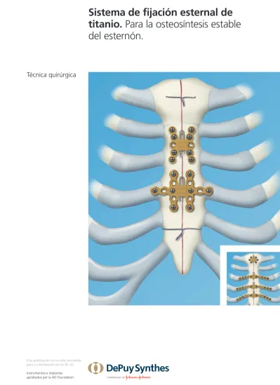 Sistema de fijación esternal de titanio. Para la osteosíntesis estable ...
