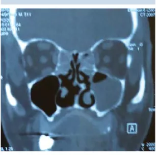 Perfil tomogrfico segn la clasificacin de Lund Mackay de pacientes ...