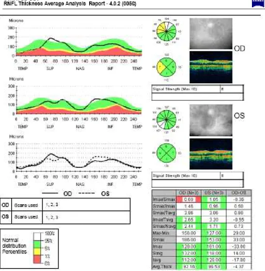 TOMOGRAFÍA RETINIANA DE HEIDELBERG (HRT) O LÁSER CONFOCAL DE BARRIDO.