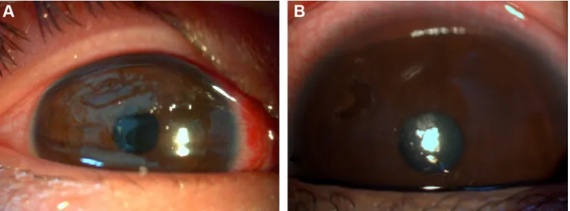 Human adenovirus type 8 epidemic keratoconjunctivitis with large ...